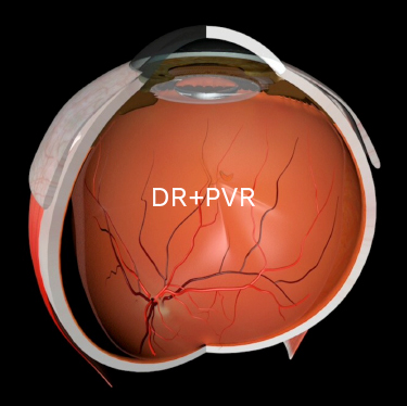 Cirugía del desprendimiento de retina (DR) con proliferación ...