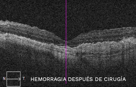 Cirugía de la Hemorragia Macular
