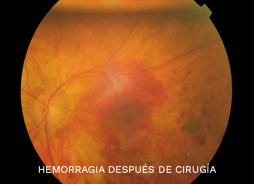Cirugía de la Hemorragia Macular