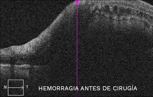 Cirugía de la Hemorragia Macular
