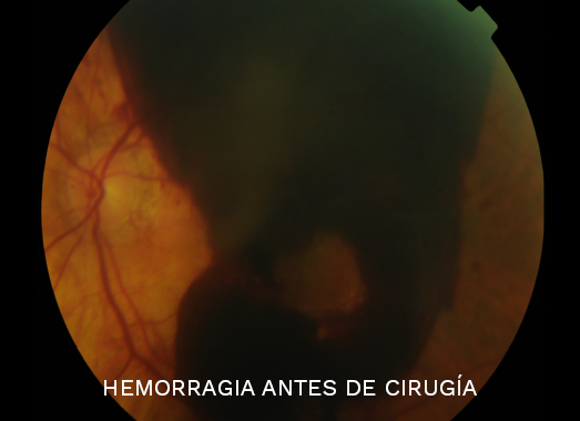 Cirugía de la Hemorragia Macular