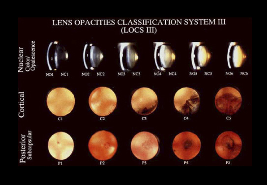 Catarata Ocular
