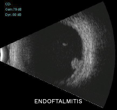 Endoftalmitis