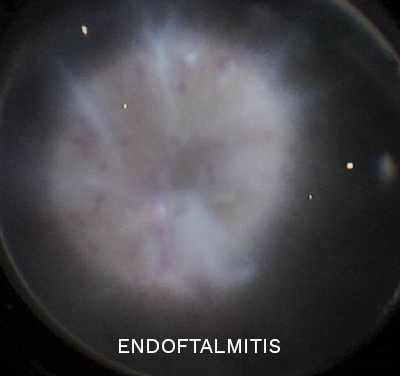 Endoftalmitis