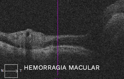 Hemorragia Macular