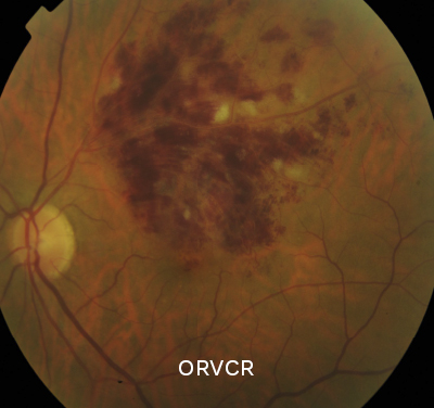 Obstrucción de Vena central y de rama de vena central de la retina